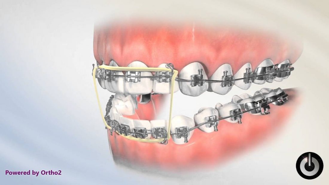 Le Quad Hélix | Orthodontie des Grands Moulins