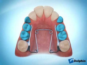 Le Quad Hélix | Orthodontie des Grands Moulins